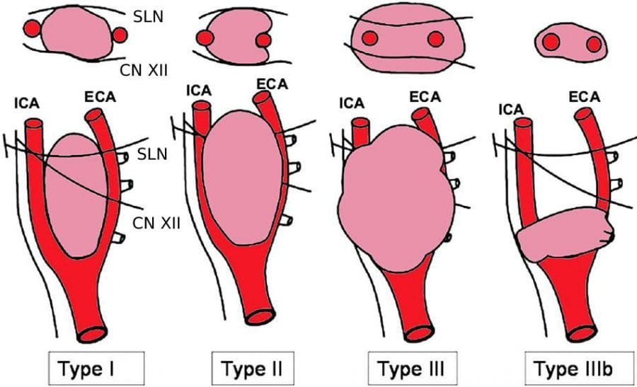 Shamblin classification of carotid body tumors - ENT, Head & Neck