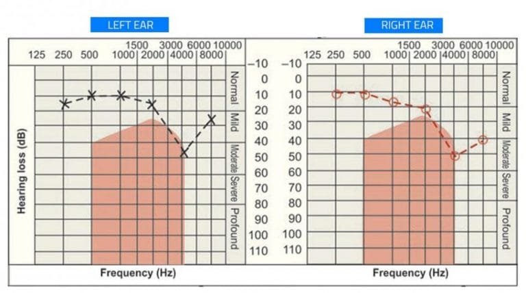 Noise Induced Hearing loss (NIHL) - Dr Sanu P Moideen