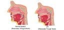 Velopharyngeal Insufficiency - Dr Sanu P Moideen