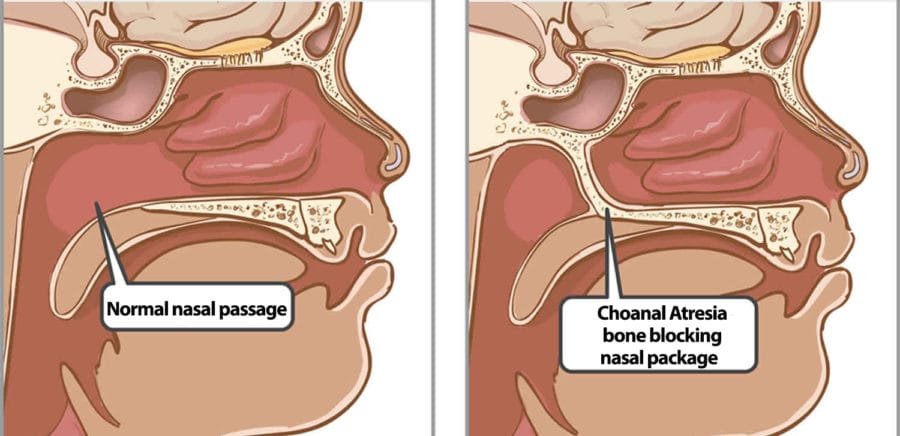Choanal Atresia - Clinical Features and Treatment