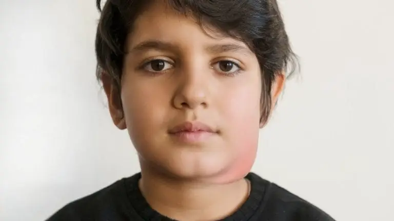 Recurrent Parotitis of Childhood / Juvenile recurrent parotitis - Dr ...