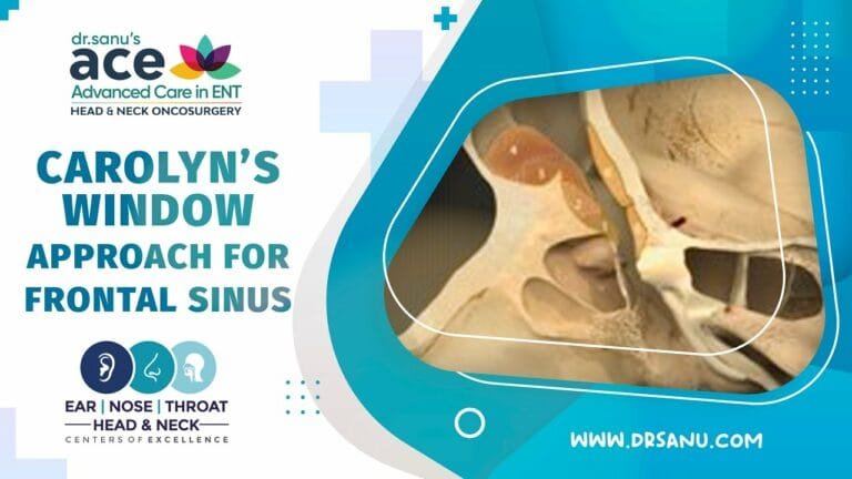 Carolyn's Window Approach To Unilateral Frontal Sinus Surgery