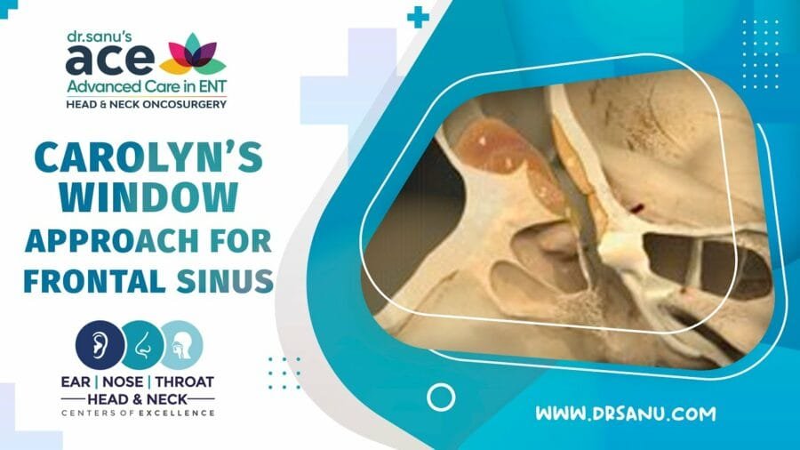 Carolyn's Window Approach To Unilateral Frontal Sinus Surgery
