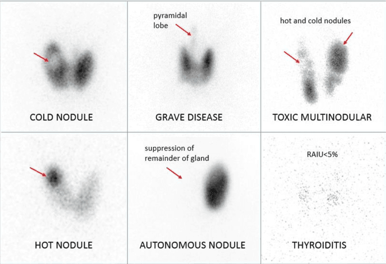 Hot vs. Cold Thyroid Nodules: Understanding Their Significance - Dr ...
