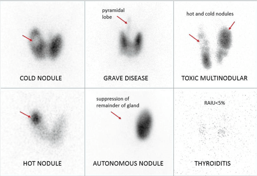 Hot vs. Cold Thyroid Nodules: Understanding Their Significance - Dr ...